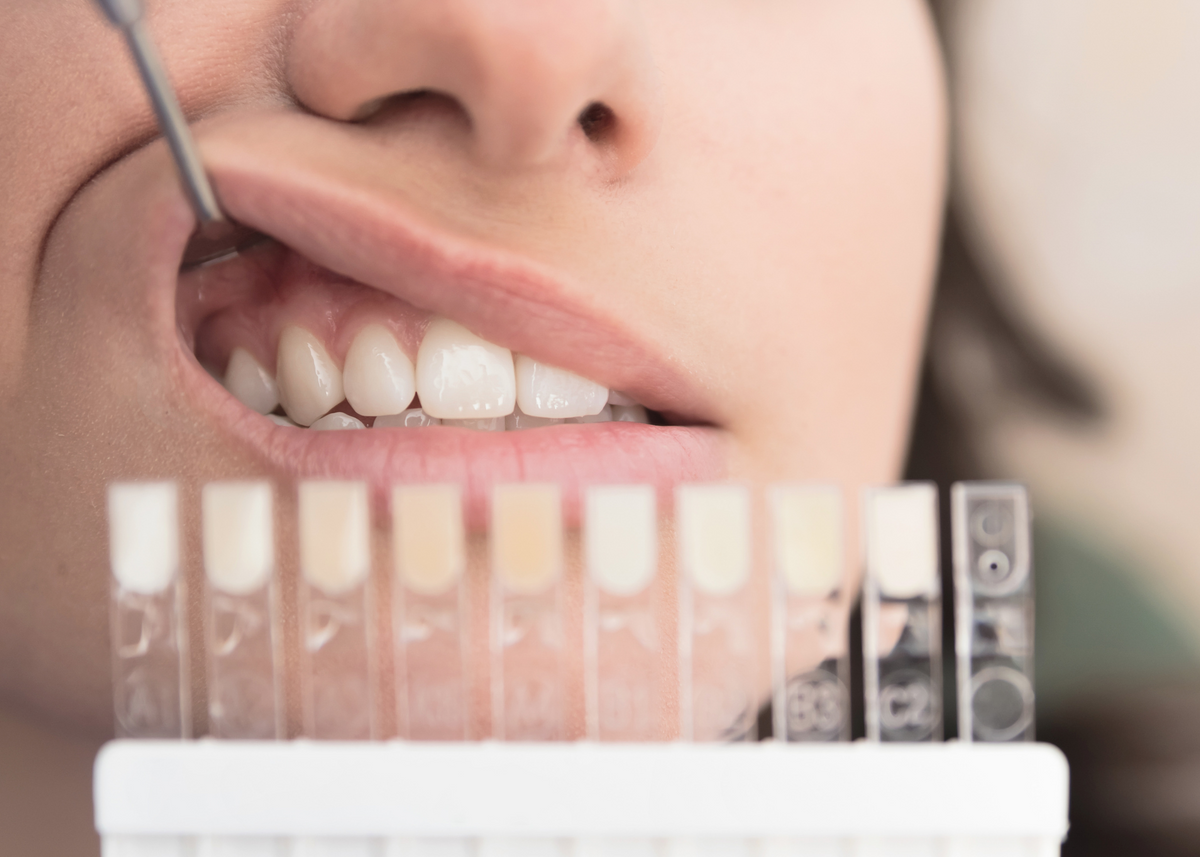 Unveiling the Magic of Color Corrector for Teeth