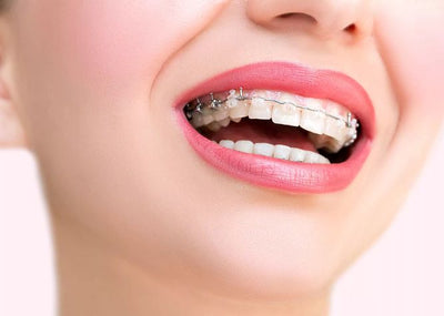 Teeth Rtainers Types: How It Works & Its Uses (2025 Guide)